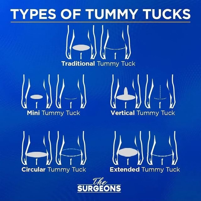 TYPES OF TUMMY TUCKS Traditional Tummy Tuck Mini Tummy Tuc Vertical ...