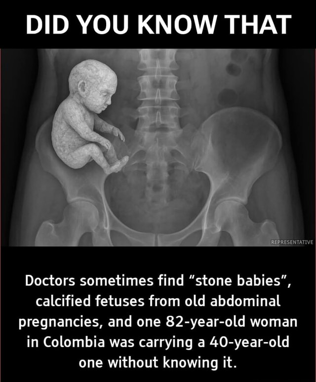 DID YOU KNOW THAT Doctors sometimes find "stone babies", calcified ...