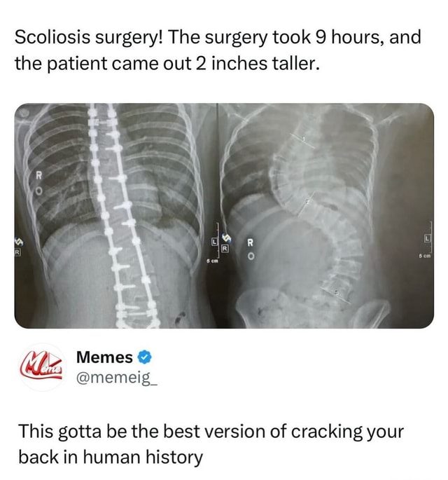 Modern Medicine memes explore wholesome photography - Scoliosis surgery ...