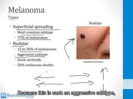 Melanoma 'Types Nodular Superficial spreading Most common subtype 75% ...
